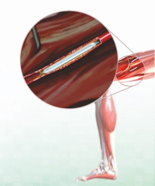 Mozec PTA Balloon Dilation Catheter • Mediterra