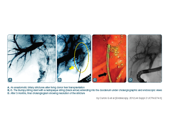 Biliary Stents • Mediterra • View the product range