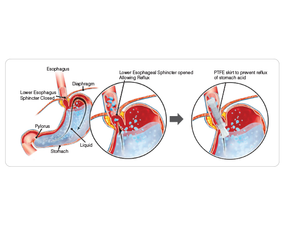 Esophageal Stents • Mediterra • View the product range