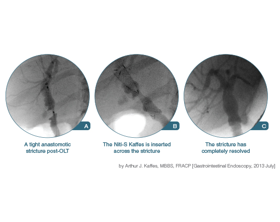 Biliary Stents • Mediterra • View the product range